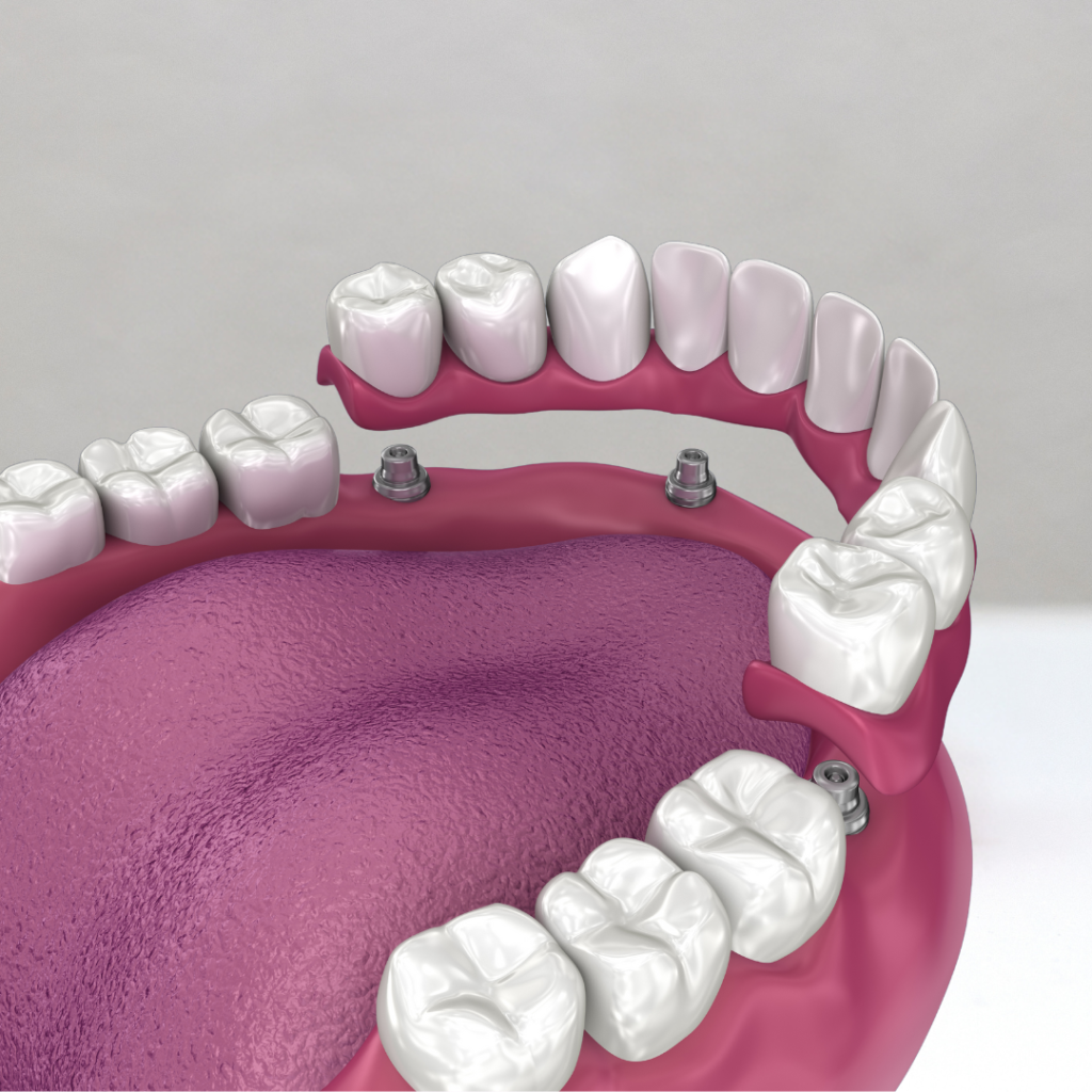 Affordable Dentures in Houston, 77023 - Full, Partial & Implant-Supported